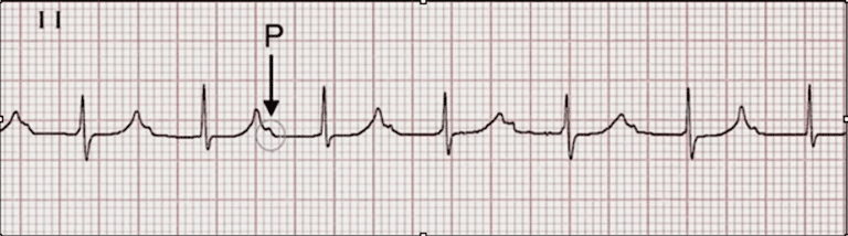 Interpreting an ECG Strip | 12-Lead ECG Resources | ACLS Certification ...