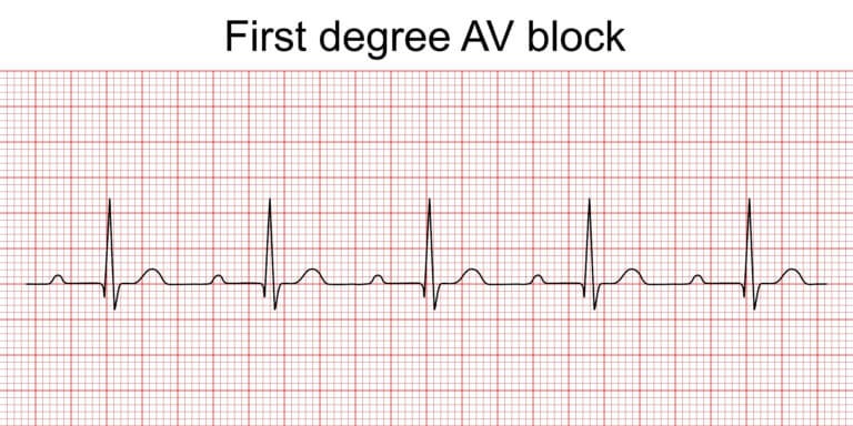 The Bradyarrhythmias | Arrhythmia Interpretation Resources | ACLS ...