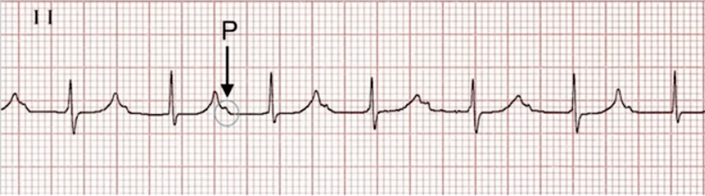 Atrioventricular Block or AV Block | 12-Lead ECG Resources | ACLS ...