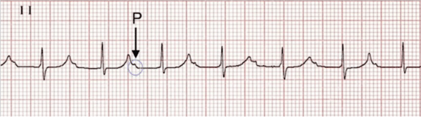Atrioventricular Block or AV Block | 12-Lead ECG Resources | ACLS ...