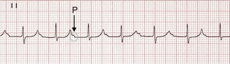 Atrioventricular Block or AV Block | 12-Lead ECG Resources | ACLS ...