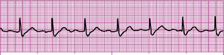 Interpreting an ECG Strip | 12-Lead ECG Resources | ACLS Certification ...
