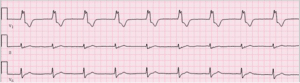 Ventricular Rhythms and Asystole | ACLS Certification Association