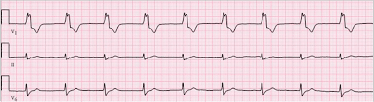 Ventricular Rhythms and Asystole | ACLS Certification Association