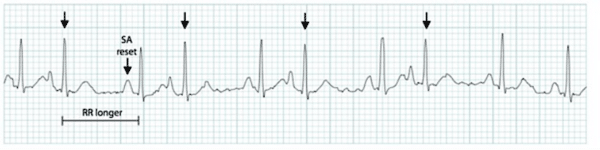 Interpreting an ECG Strip | 12-Lead ECG Resources | ACLS Certification ...