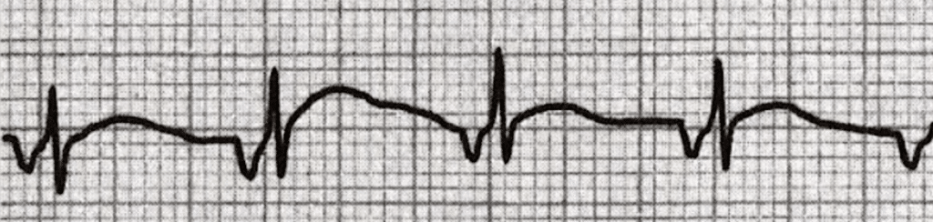 Junctional Rhythms: ECG Characteristics, Causes, and Treatment