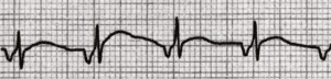 Junctional Rhythms: ECG Characteristics, Causes, and Treatment