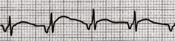 Junctional Rhythms | 12-Lead ECG Resources | ACLS Certification Association