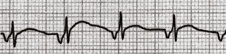 Junctional Rhythms: ECG Characteristics, Causes, and Treatment