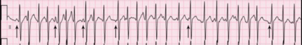 Rhythms Originating from the Atrium | 12-Lead ECG Resources | ACLS ...
