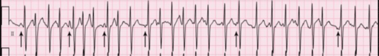 Rhythms Originating from the Atrium | 12-Lead ECG Resources | ACLS ...
