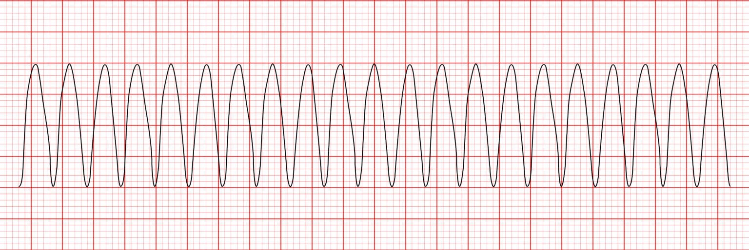 The Unstable Patient in Tachycardia | ACLS Resources | ACLS ...
