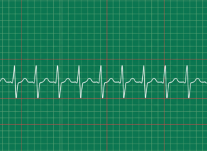 EKG & ECG Interpretation Explained | ACLS Certification Association