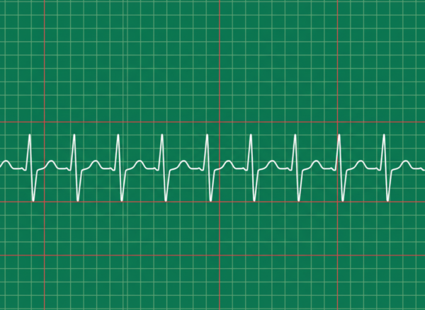 EKG & ECG Interpretation Explained | ACLS Certification Association