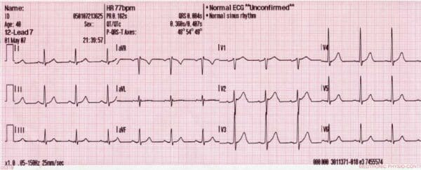 EKG & ECG Interpretation Explained | 12-Lead ECG Resources | ACLS ...