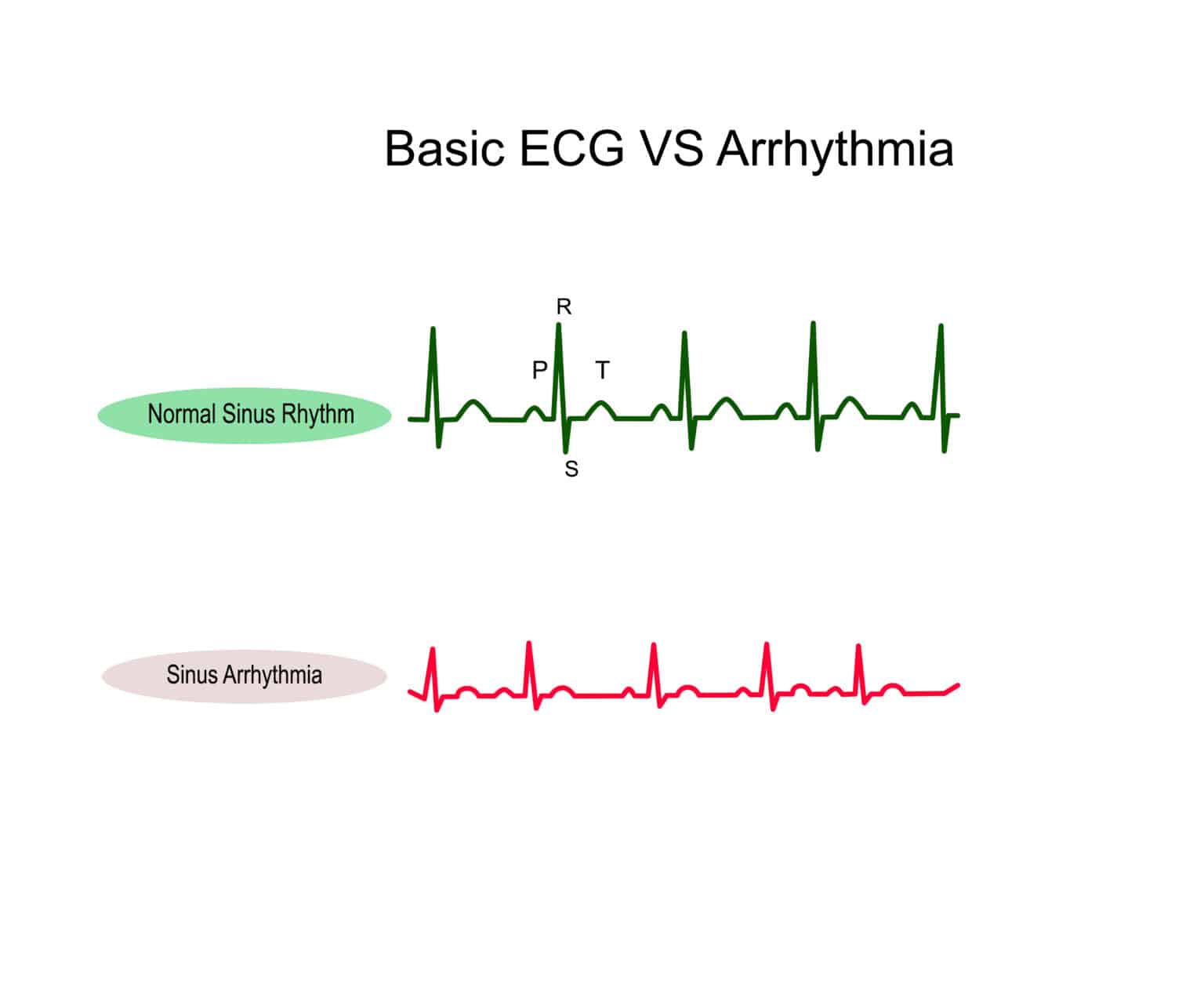 Normal Sinus Rhythm, Sinus Bradycardia, Tachycardia & Arrhythmias | 12 ...