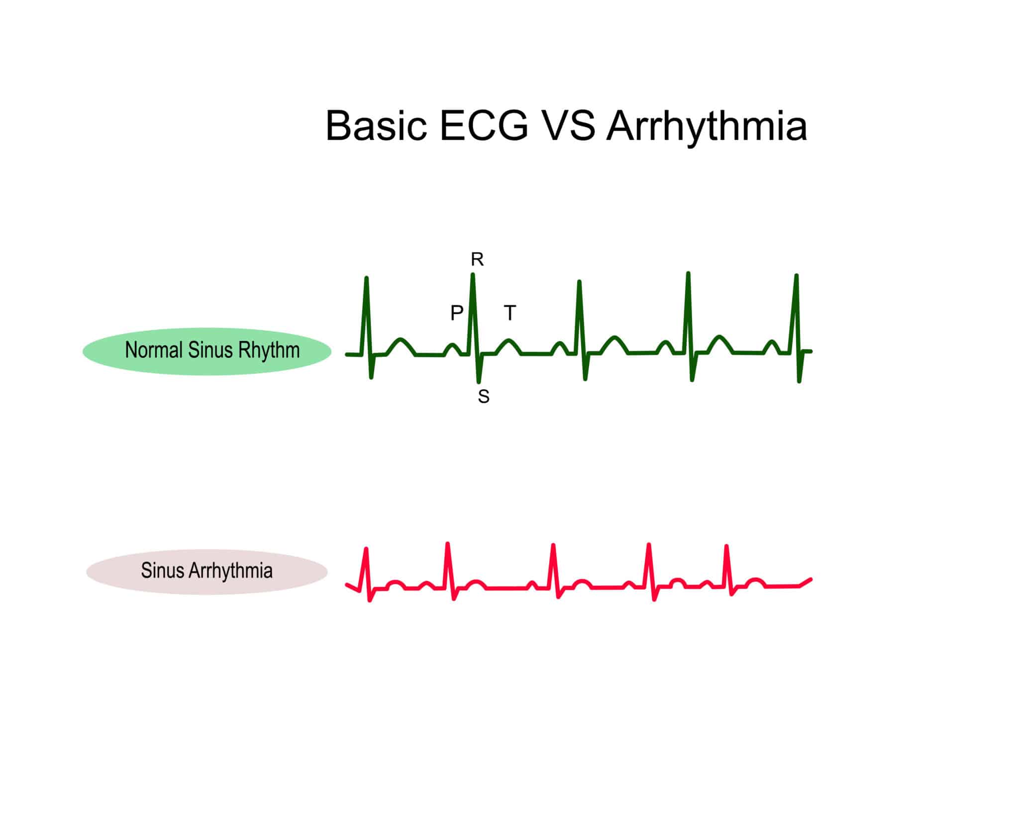 Normal Sinus Rhythm, Sinus Bradycardia, Tachycardia & Arrhythmias | 12 ...