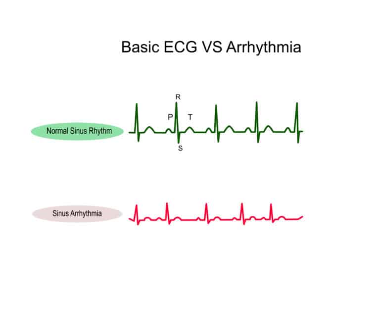 Normal Sinus Rhythm, Sinus Bradycardia, Tachycardia & Arrhythmias | 12 ...