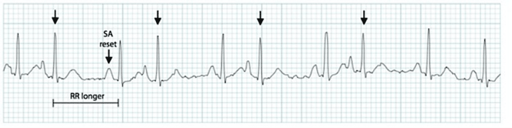 Rhythms Originating from the Atrium | 12-Lead ECG Resources | ACLS ...