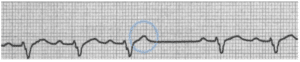 Rhythms Originating from the Atrium | 12-Lead ECG Resources | ACLS ...