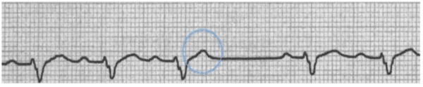 Rhythms Originating from the Atrium | 12-Lead ECG Resources | ACLS ...