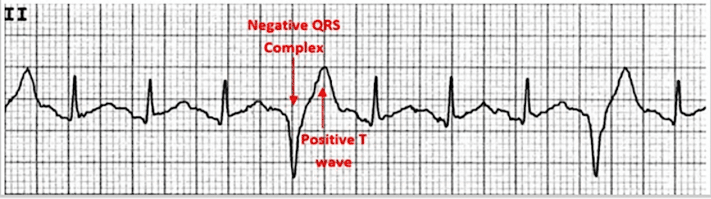 Ventricular Rhythms and Asystole | Arrhythmia Interpretation Resources ...