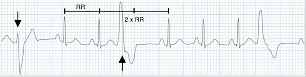 Ventricular Rhythms and Asystole | ACLS Certification Association