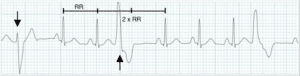 Ventricular Rhythms and Asystole | Arrhythmia Interpretation Resources ...