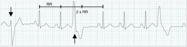 Ventricular Rhythms and Asystole | Arrhythmia Interpretation Resources ...
