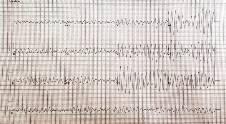 Wide QRS-Complex Tachycardia | ACLS Certification Association