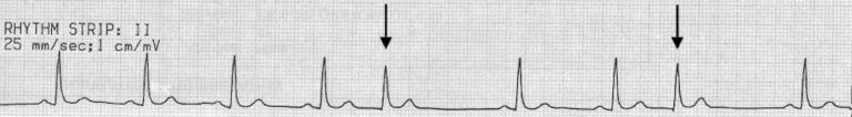 Junctional Rhythms | 12-Lead ECG Resources | ACLS Certification Association