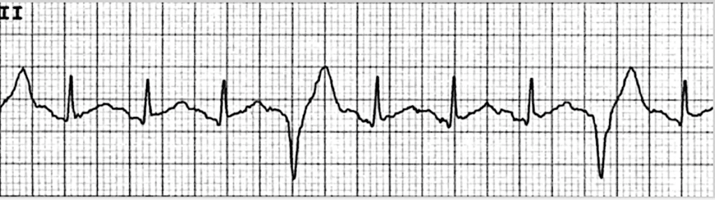 Ventricular Rhythms and Asystole | Arrhythmia Interpretation Resources ...