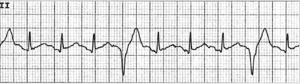 Ventricular Rhythms and Asystole | Arrhythmia Interpretation Resources ...