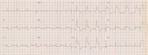 Managing STEMI | ACLS Resources | ACLS Certification Association