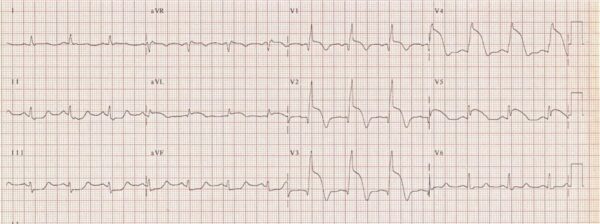 Managing STEMI | ACLS Resources | ACLS Certification Association