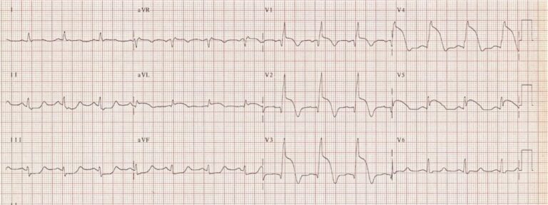 Managing STEMI | ACLS Resources | ACLS Certification Association