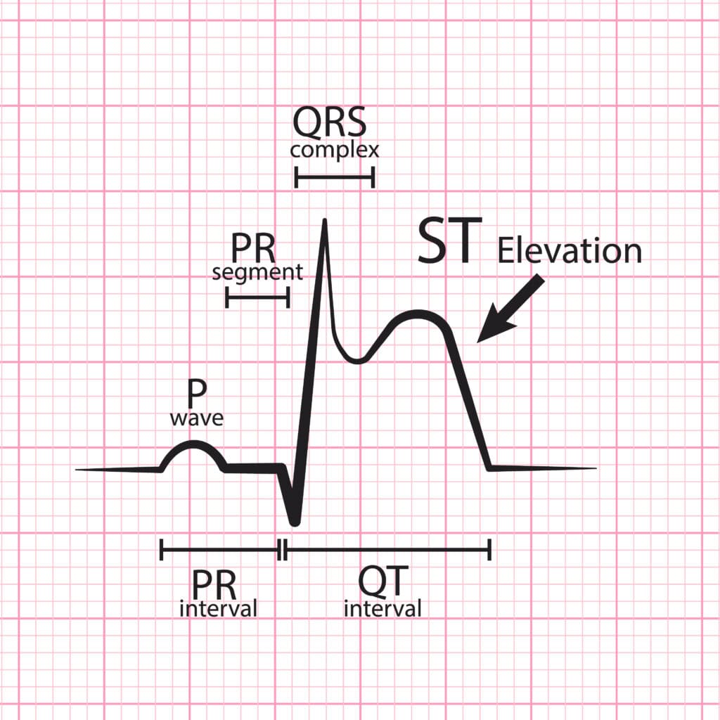ACS And STEMI Systems of Care | ACLS Resources | ACLS Certification ...
