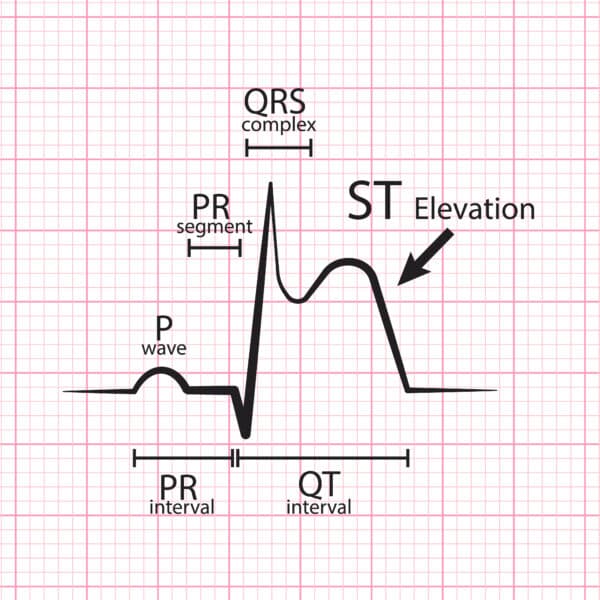 ACS And STEMI Systems of Care | ACLS Resources | ACLS Certification ...