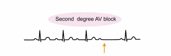 Bradyarrhythmias: ACLS Identification & Treatment Guide