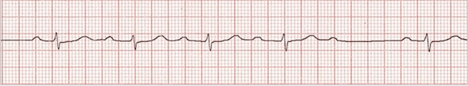 Atrioventricular Block or AV Block | 12-Lead ECG Resources | ACLS ...