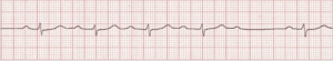 Atrioventricular Block or AV Block | 12-Lead ECG Resources | ACLS ...