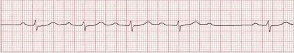 Atrioventricular Block or AV Block | 12-Lead ECG Resources | ACLS ...