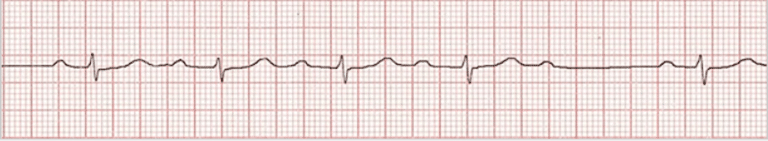 Atrioventricular Block or AV Block | 12-Lead ECG Resources | ACLS ...