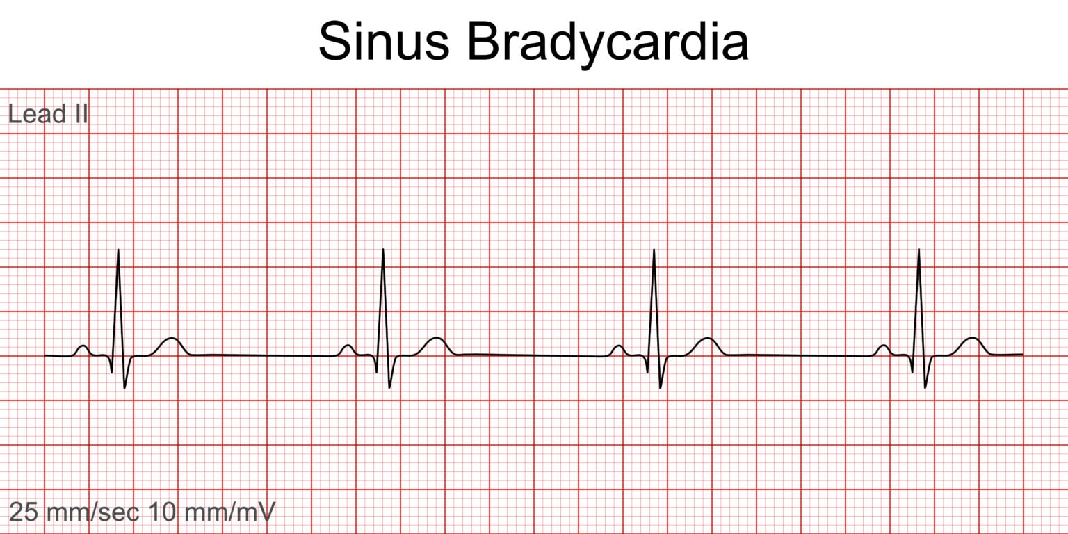 The Bradyarrhythmias | Arrhythmia Interpretation Resources | ACLS ...