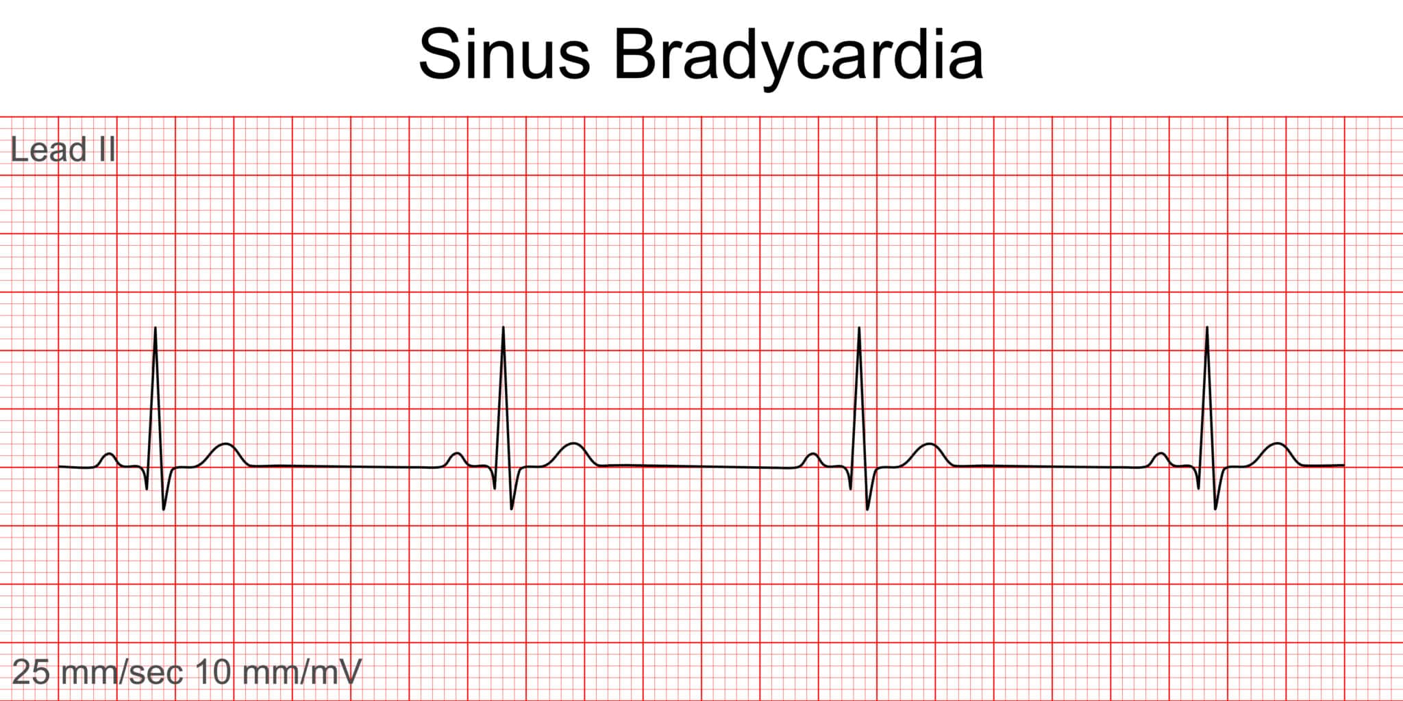 The Bradyarrhythmias | Arrhythmia Interpretation Resources | ACLS ...