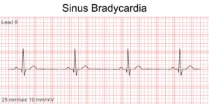 The Bradyarrhythmias | Arrhythmia Interpretation Resources | ACLS ...