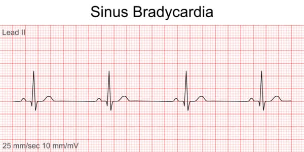 The Bradyarrhythmias | Arrhythmia Interpretation Resources | ACLS ...