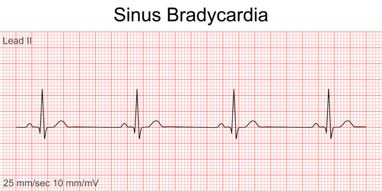 The Bradyarrhythmias | Arrhythmia Interpretation Resources | ACLS ...