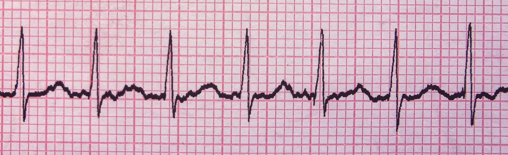 The Unstable Patient in Tachycardia | ACLS Resources | ACLS ...