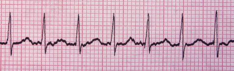 The Unstable Patient in Tachycardia | ACLS Resources | ACLS ...